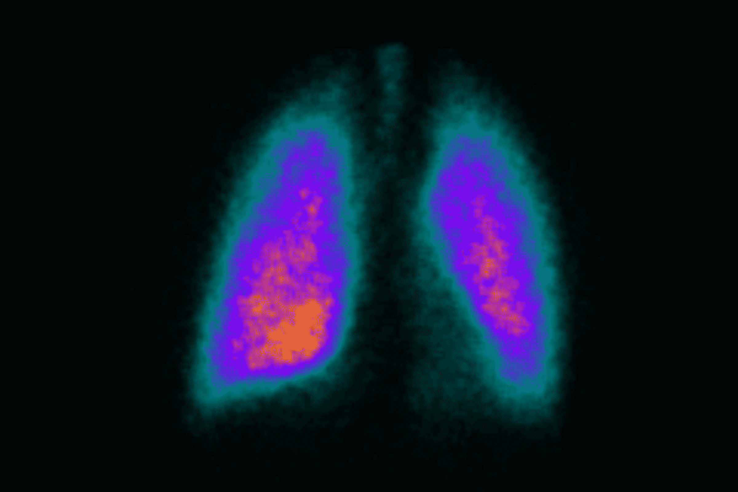 COPD Study on BGF Inhaler in COPD Patients | Scintigraphy | Simbec-Orion